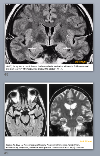 Limbic system – Brain – bit by bit