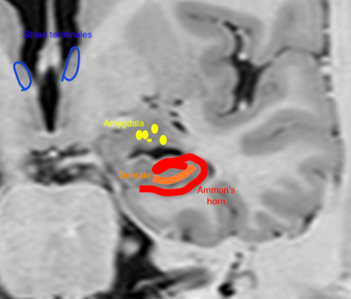 Limbic system – Brain – bit by bit