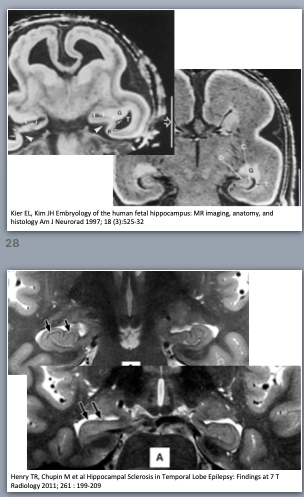 Limbic system – Brain – bit by bit