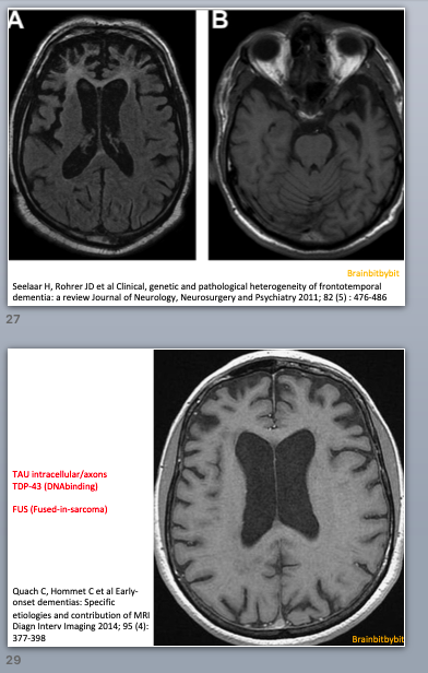Neocortex – Brain – bit by bit