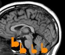 Limbic system – Brain – bit by bit