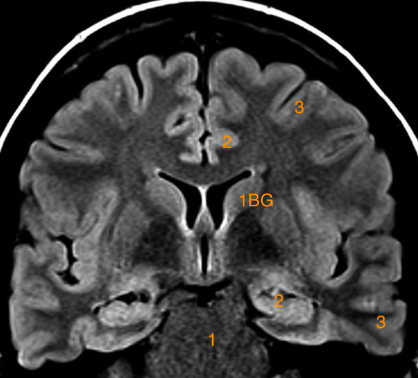 Limbic system – Brain – bit by bit
