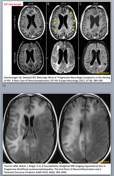 White matter – Brain – bit by bit