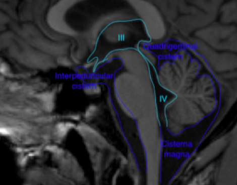 CSF spaces – Brain – bit by bit